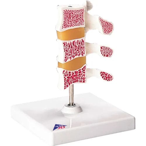 Anatomical Model - Deluxe Osteoporosis (3 Vertebrae)– Centerline Dynamics