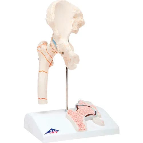 Anatomical Model - Femoral Fracture and Hip Osteoarthritis– Centerline ...